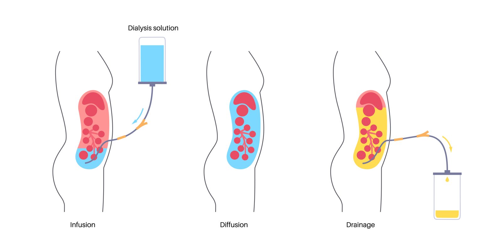 Peritoneal Dialysis Basics - Renes Care